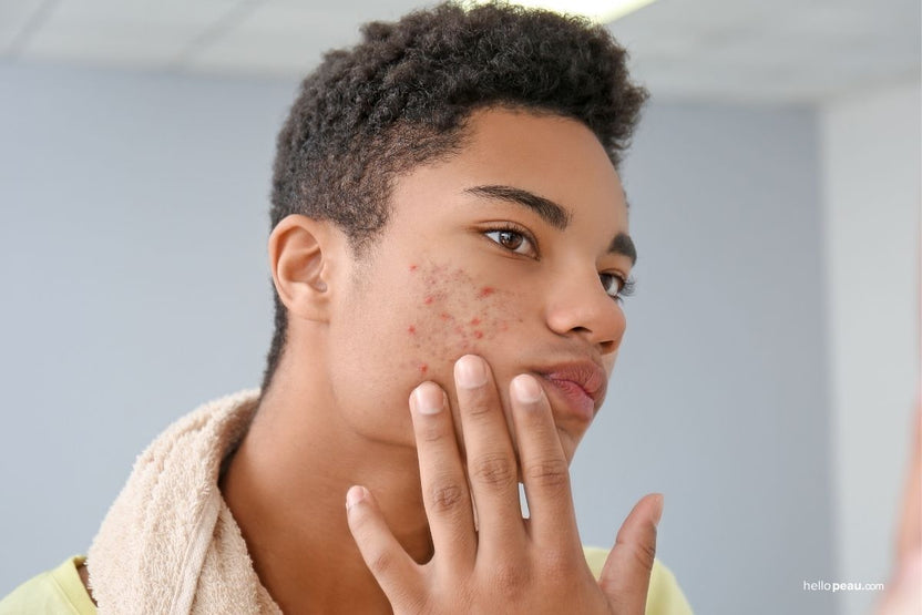 Should I Put a Pimple Patch on a Popped Pimple? – Hello Peau